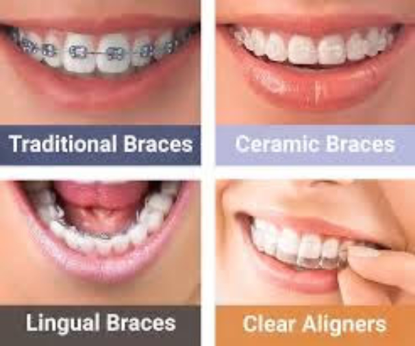Adult Braces - Frazer Dental